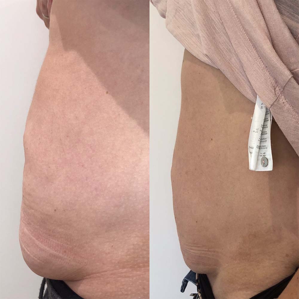 Aqualyx Fat Dissolving | The Country Clinic | Yeovil & Taunton, Somerset