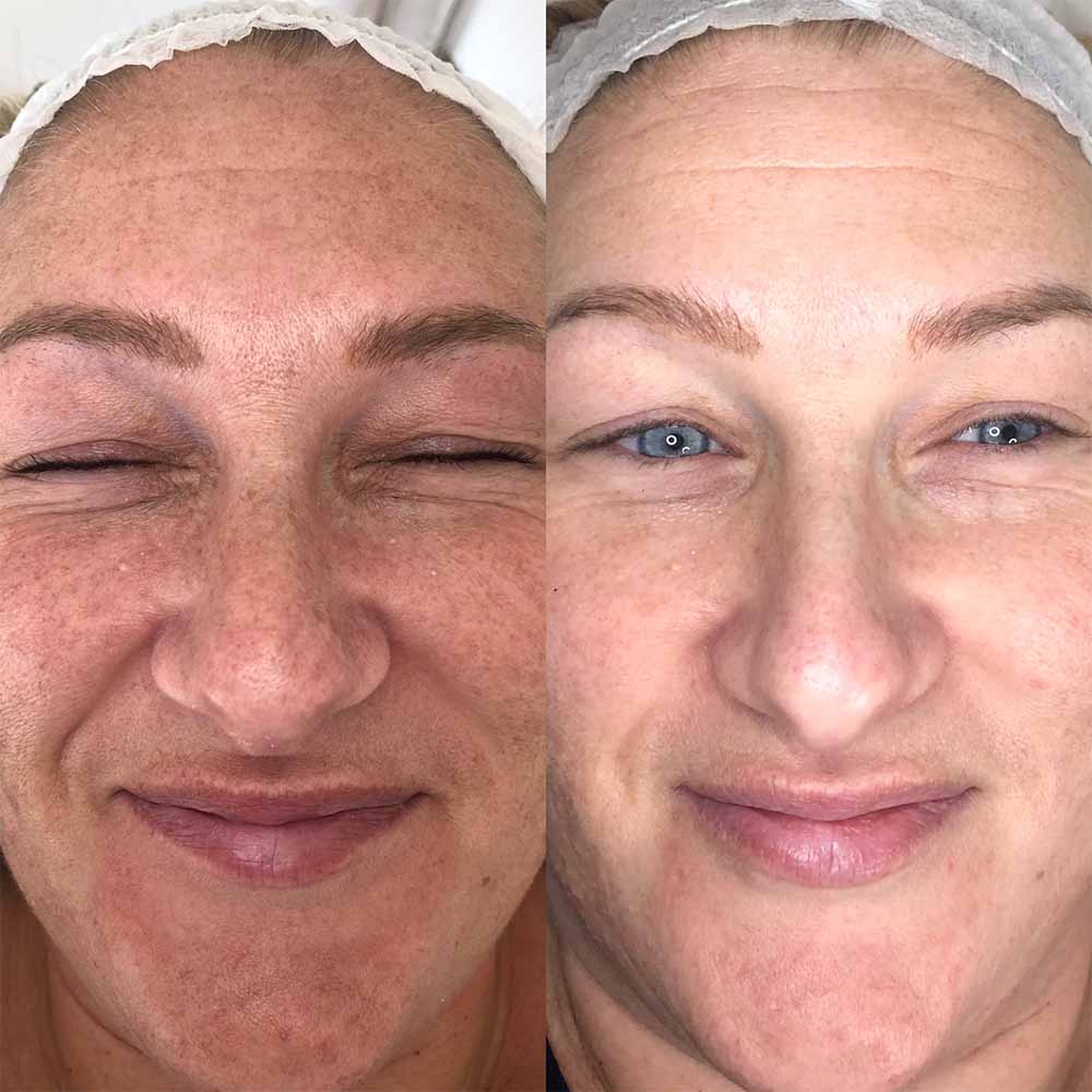 PCA Skin Professional Peels in Somerset | The Country Clinic | Curry Rivel